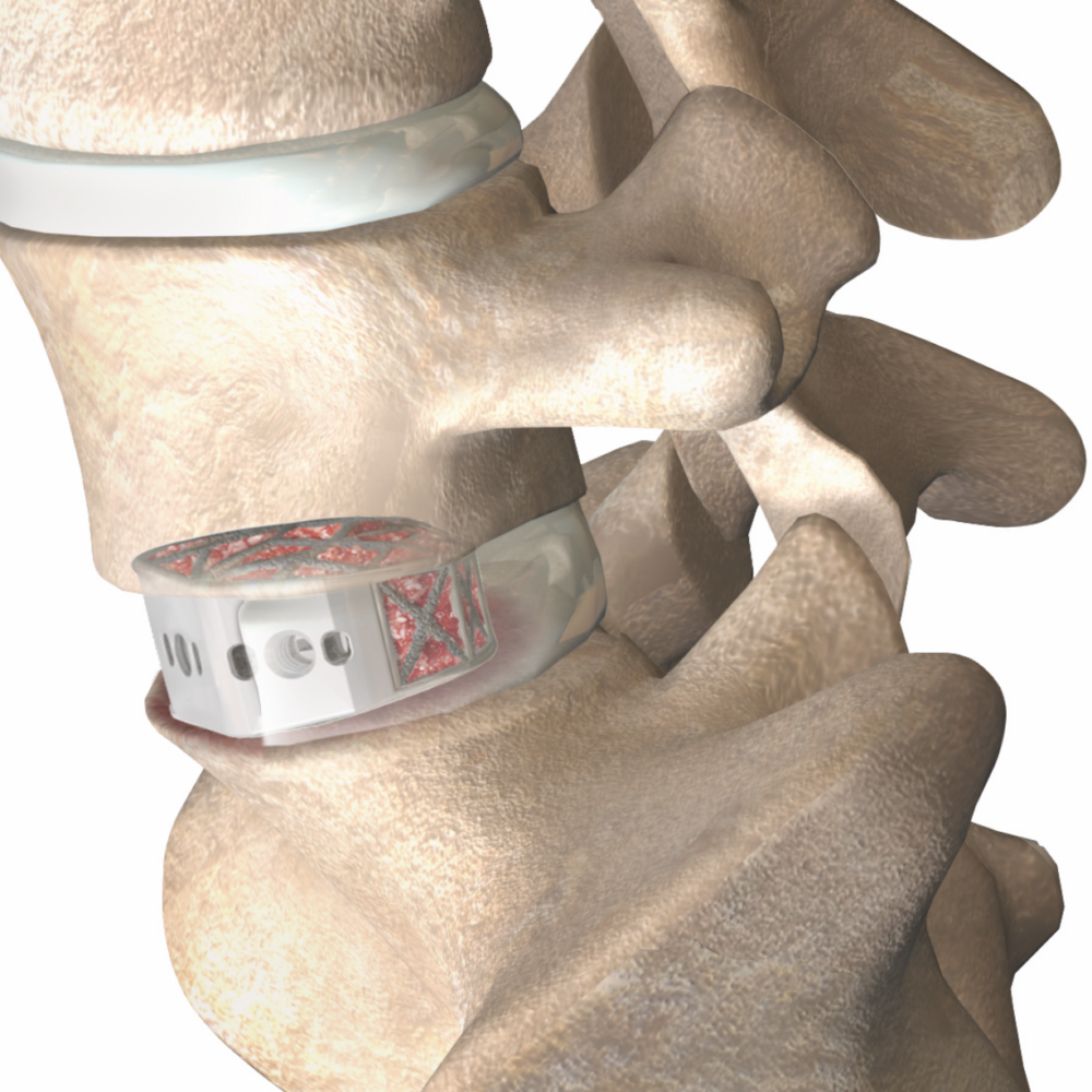 Anterior Spine Truss System™ - 4WEB