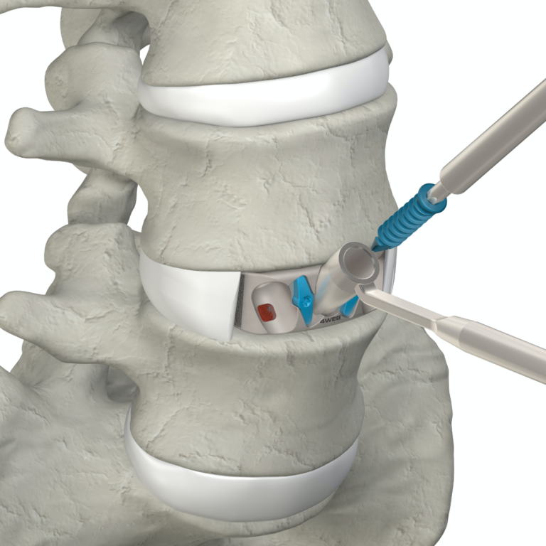 Anterior Spine Truss System™ - Stand Alone - 4WEB