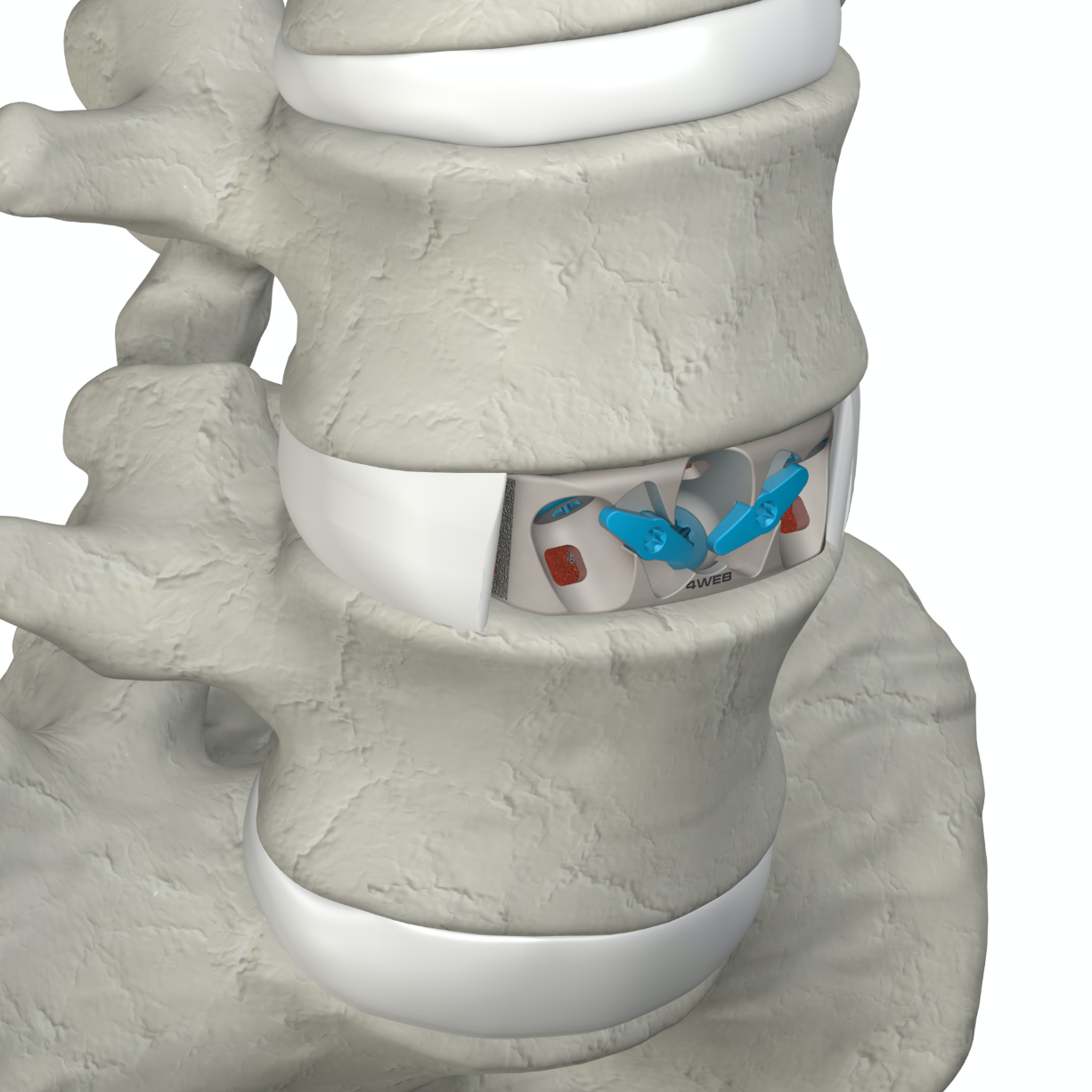 Anterior Spine Truss System™ - Stand Alone - 4WEB