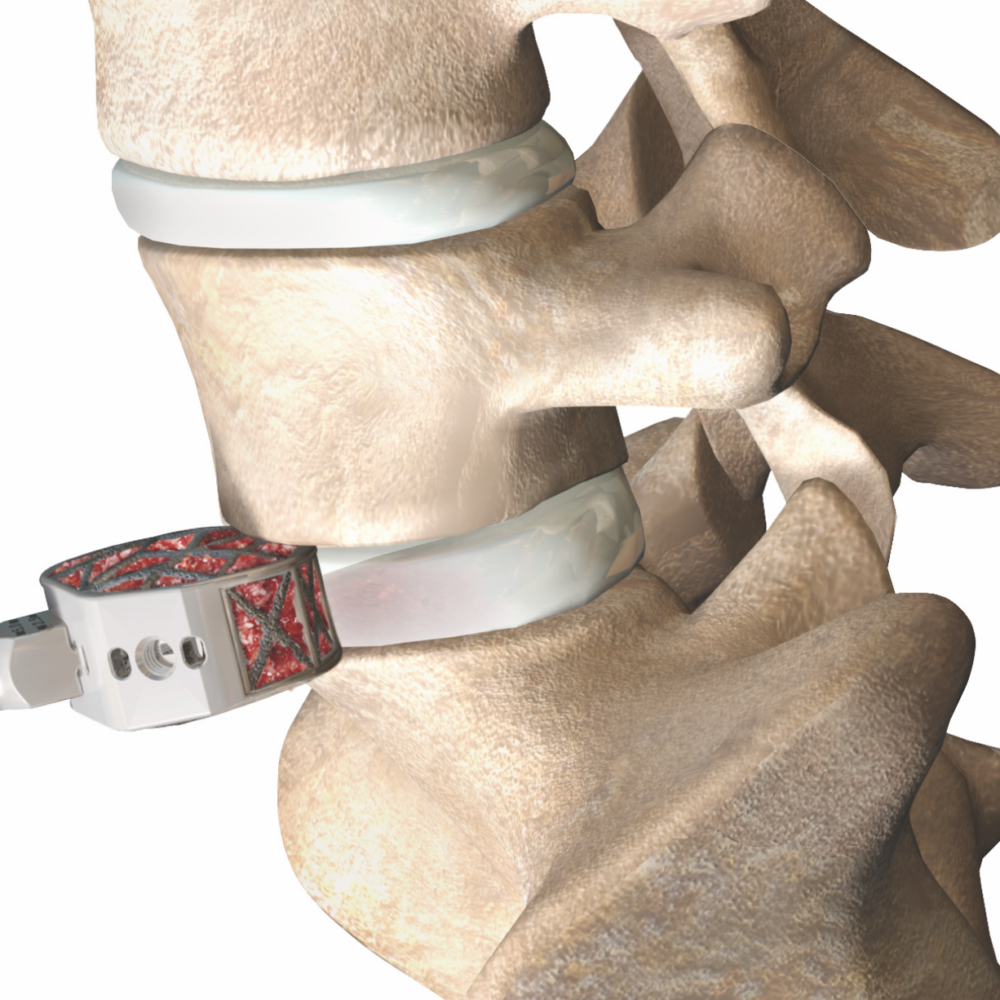 Anterior Spine Truss System™ - 4WEB