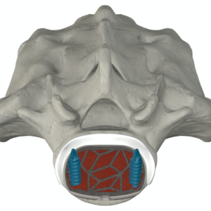 Anterior Spine Truss System™ - Stand Alone - 4WEB