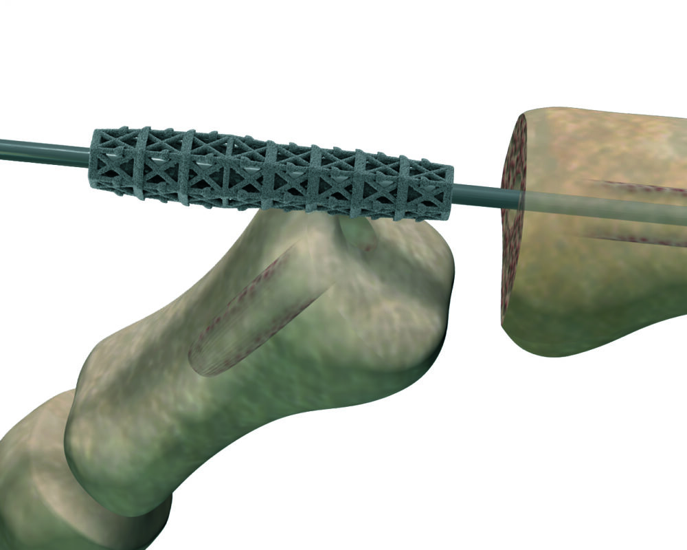 Hammertoe Truss System™ - 4WEB