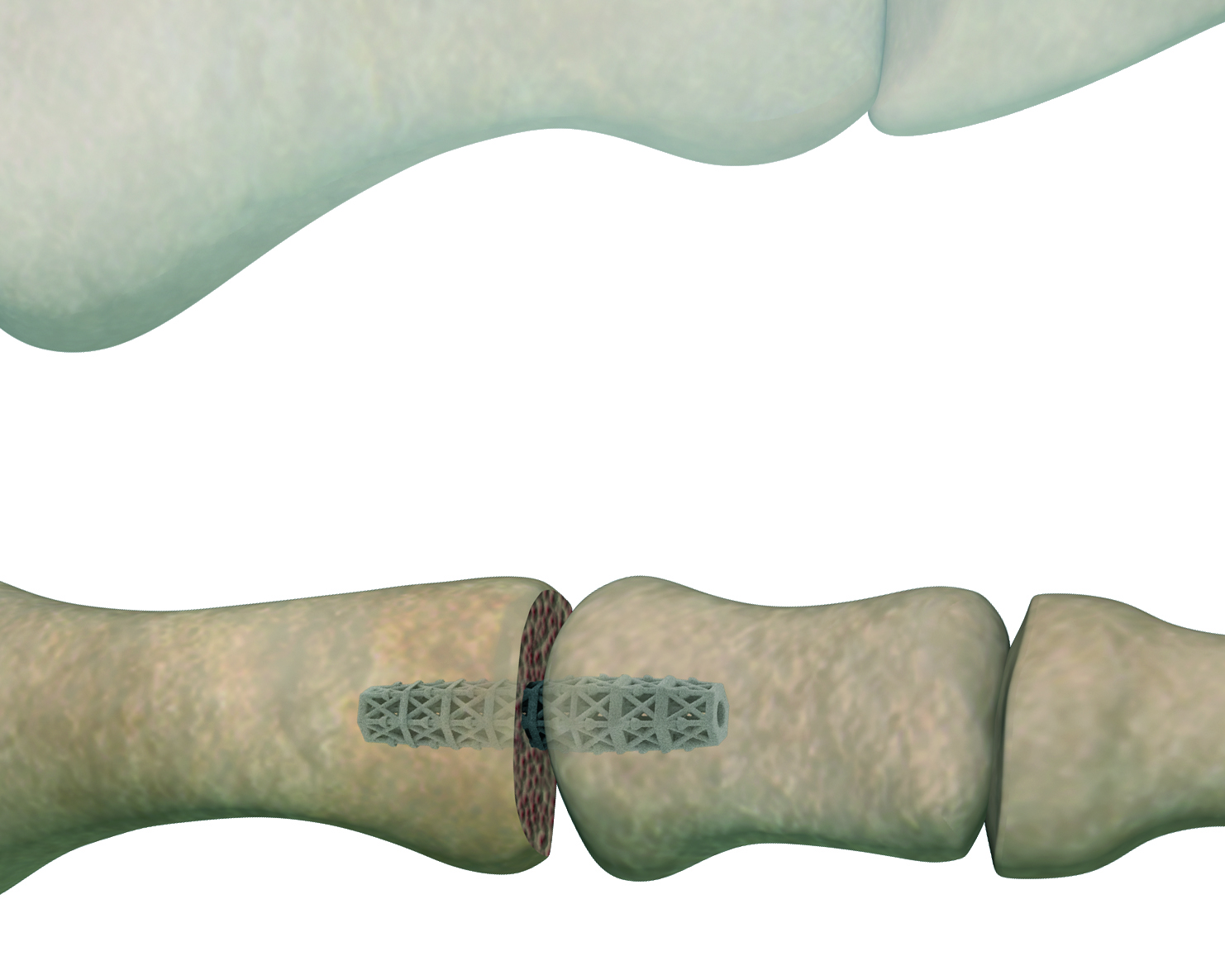 Hammertoe Truss System™ - 4WEB