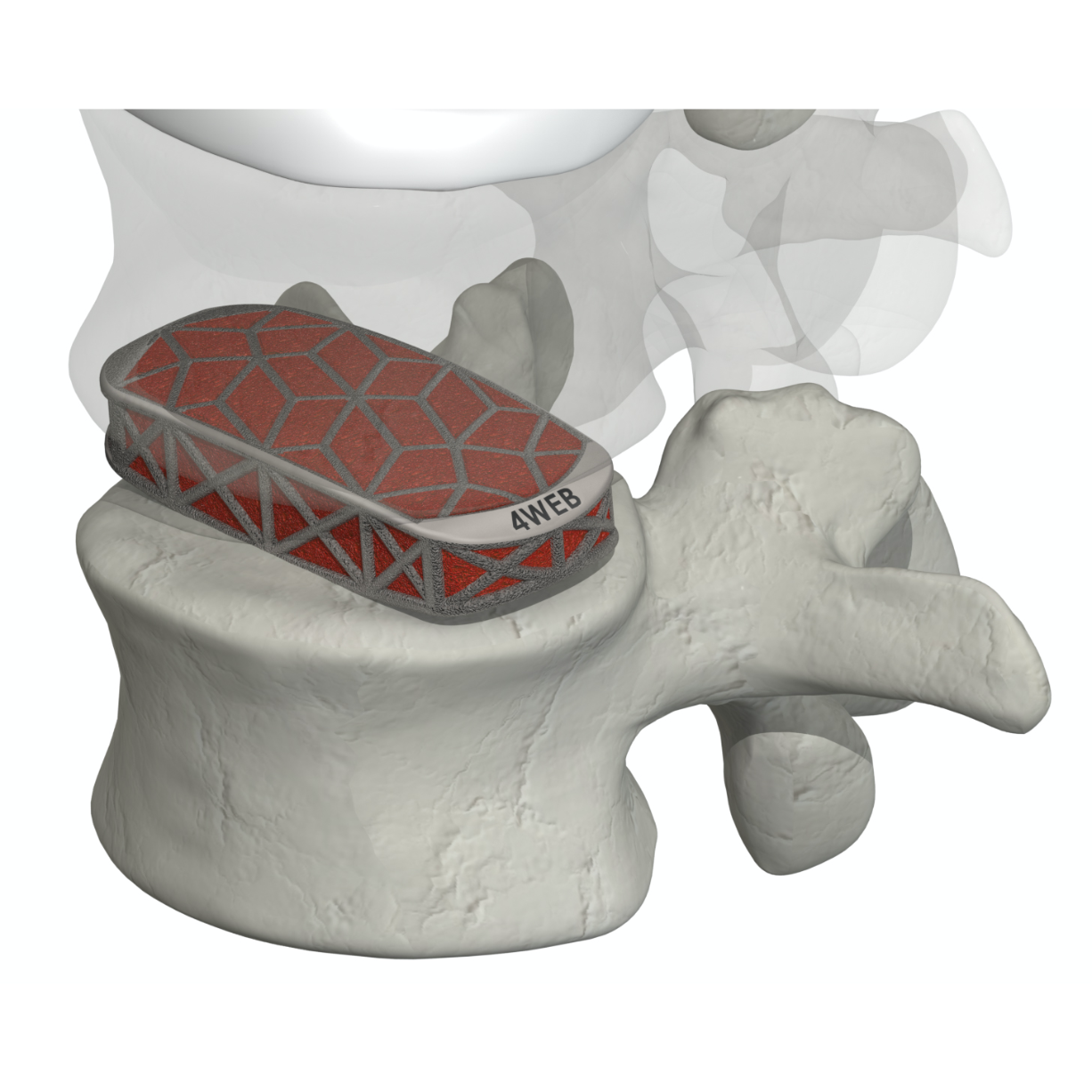 Lateral Spine Truss System™ - 4WEB