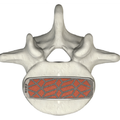 Lateral Spine Truss System™ - 4WEB
