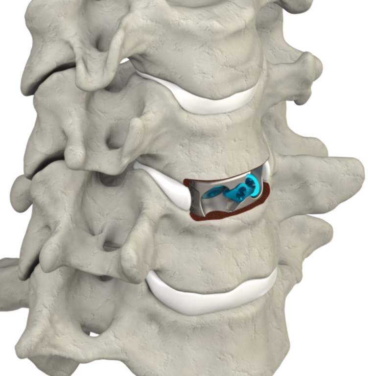 Cervical Spine Truss System™ - Stand Alone - 4WEB
