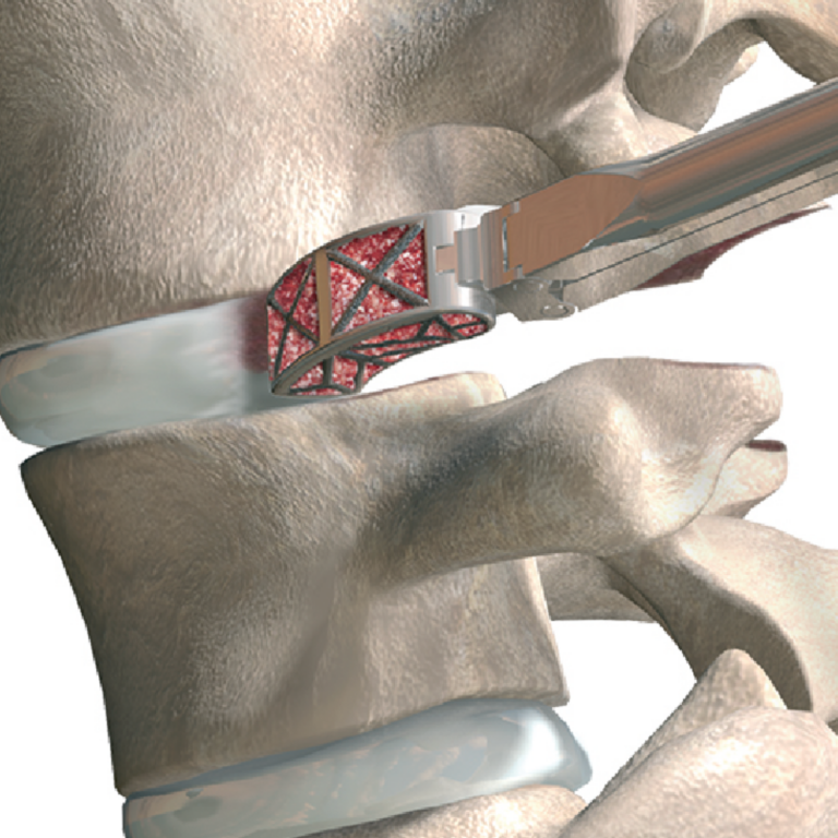 Posterior Spine Truss System™ - 4WEB