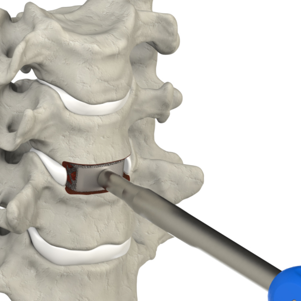 Cervical Spine Truss System™ - 4WEB Medical