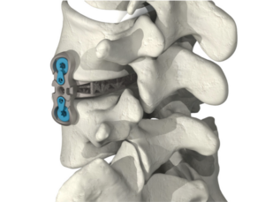 Lumbar Spine Truss System Plating Solution™ - 4WEB