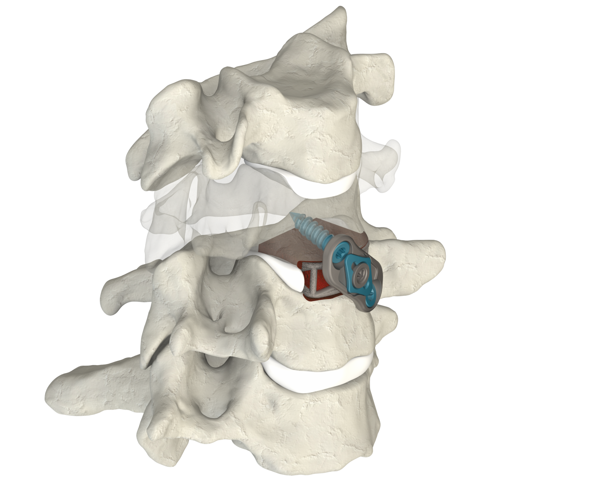 Cervical Spine Truss System™ 2.0 – Integrated Plate - 4WEB