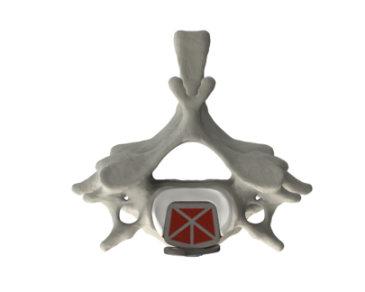 Cervical Spine Truss System™ 2.0 – Integrated Plate - 4WEB