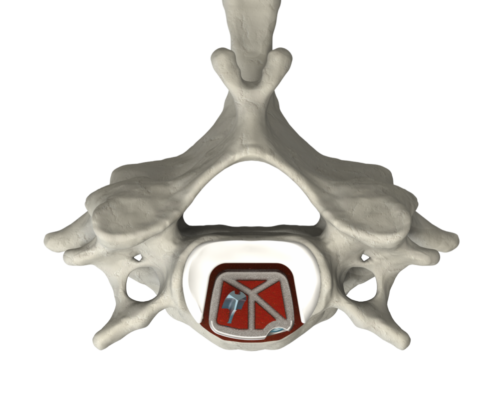 Cervical Spine Truss System™ - Anchor Fixation - 4WEB