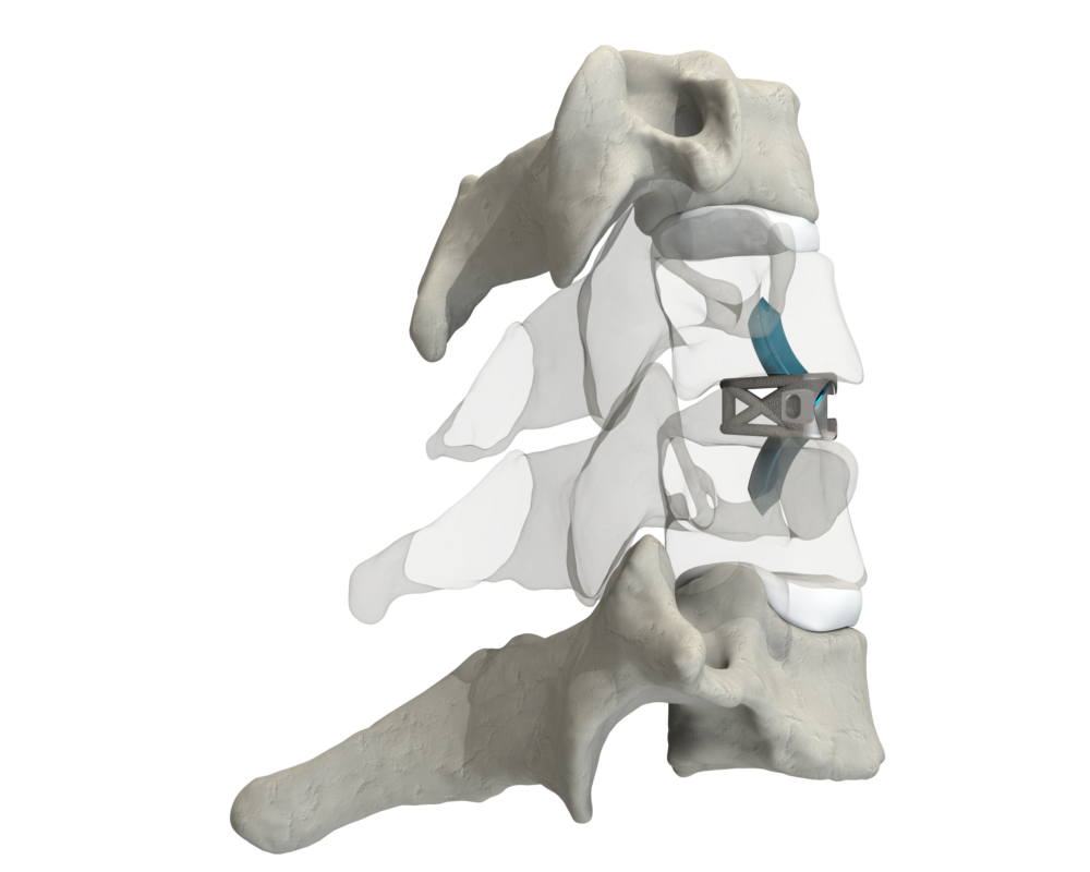 Cervical Spine Truss System™ - Anchor Fixation - 4WEB